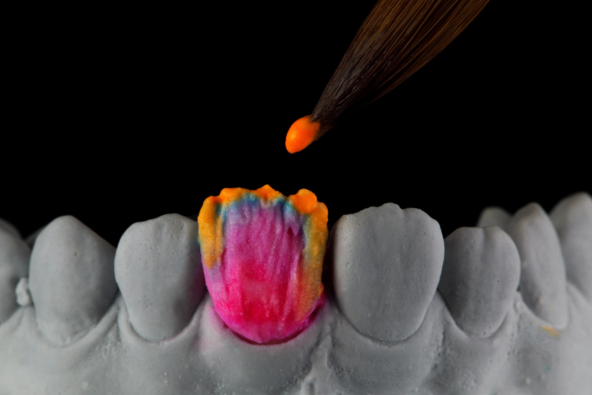 Licówki porcelanowe – protetyka Jabłonna - Diamond Clinic